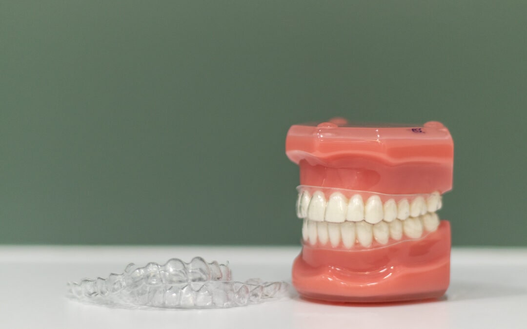 How Retainers Maintain Your New Smile After Aligners